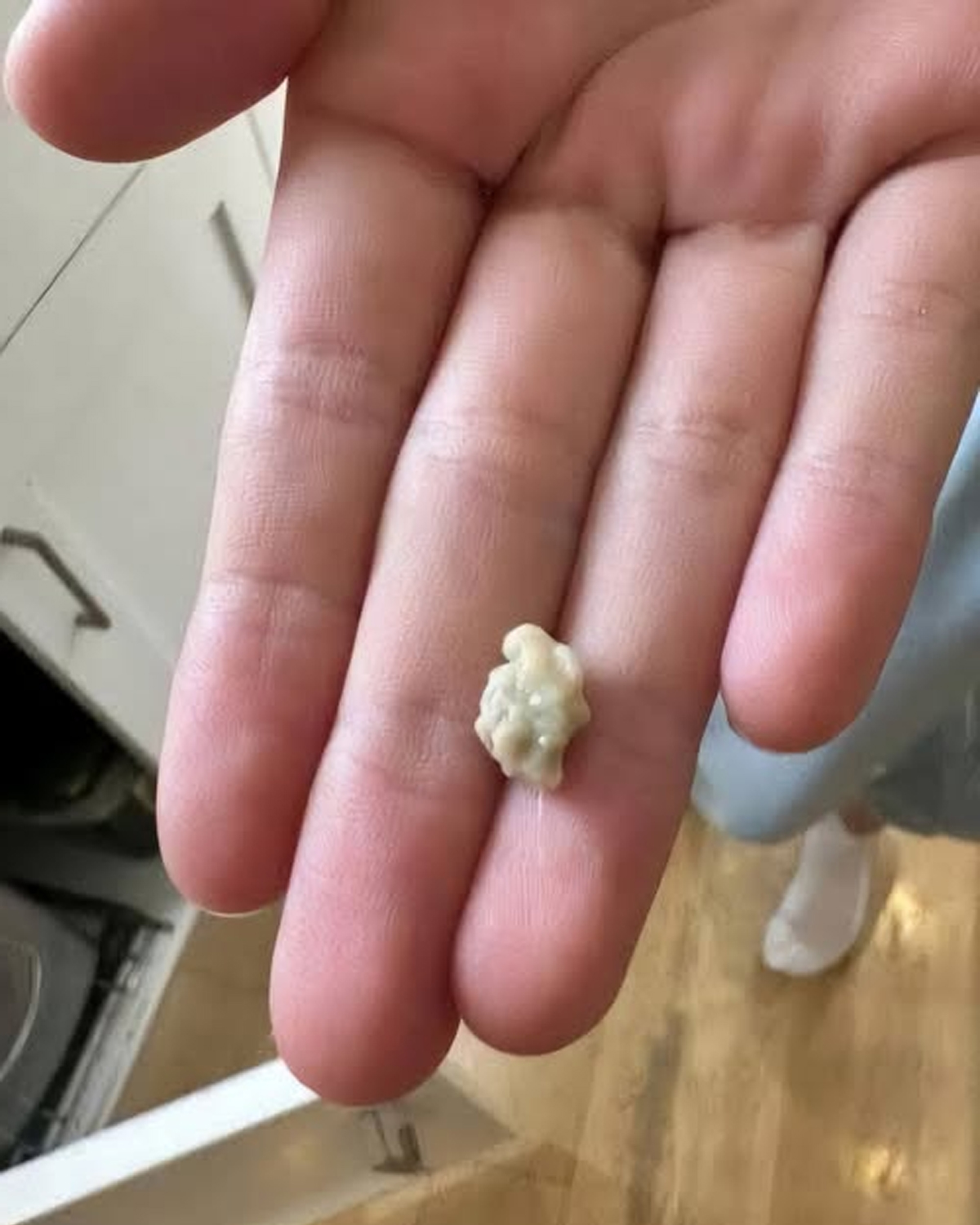 Here’s What You Need to Know About Tonsil Stones